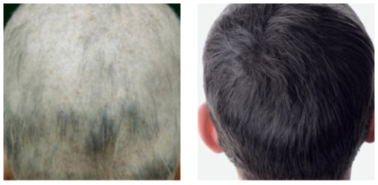 IsoBlom Capsules | Nuvectra Medical