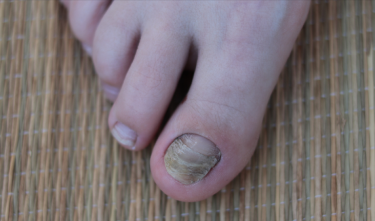 Does Crystal Flush Work For Toenail Fungus? A Comprehensive Review