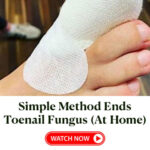 Penlac for Toenail Fungus: How to Use It Effectively?